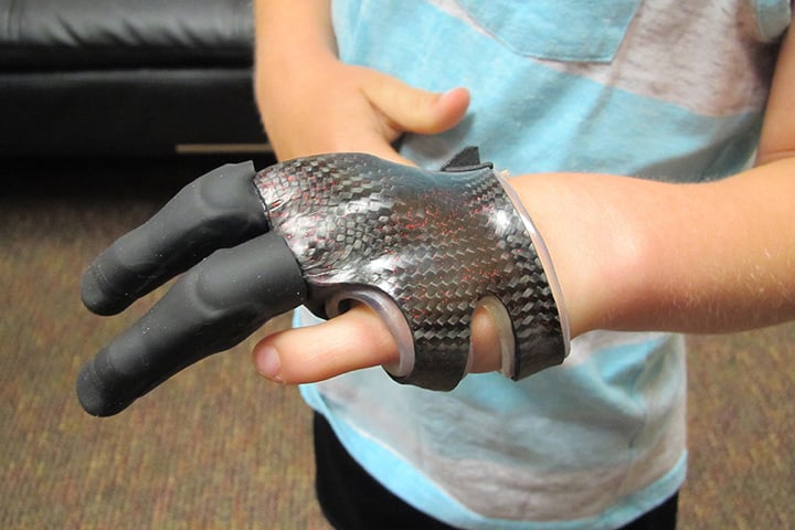 Prosthetic Terminal Devices for Babies, Children and Adolescents with ...